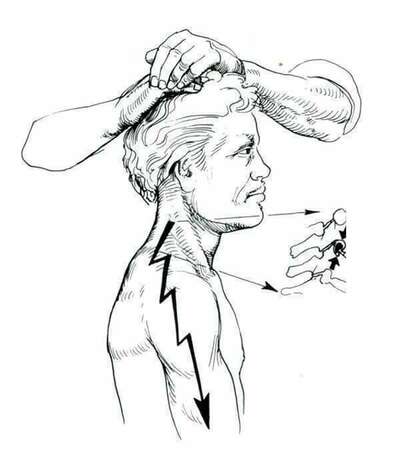 La Névralgie Cervico-Brachiale et l'ostéopathie