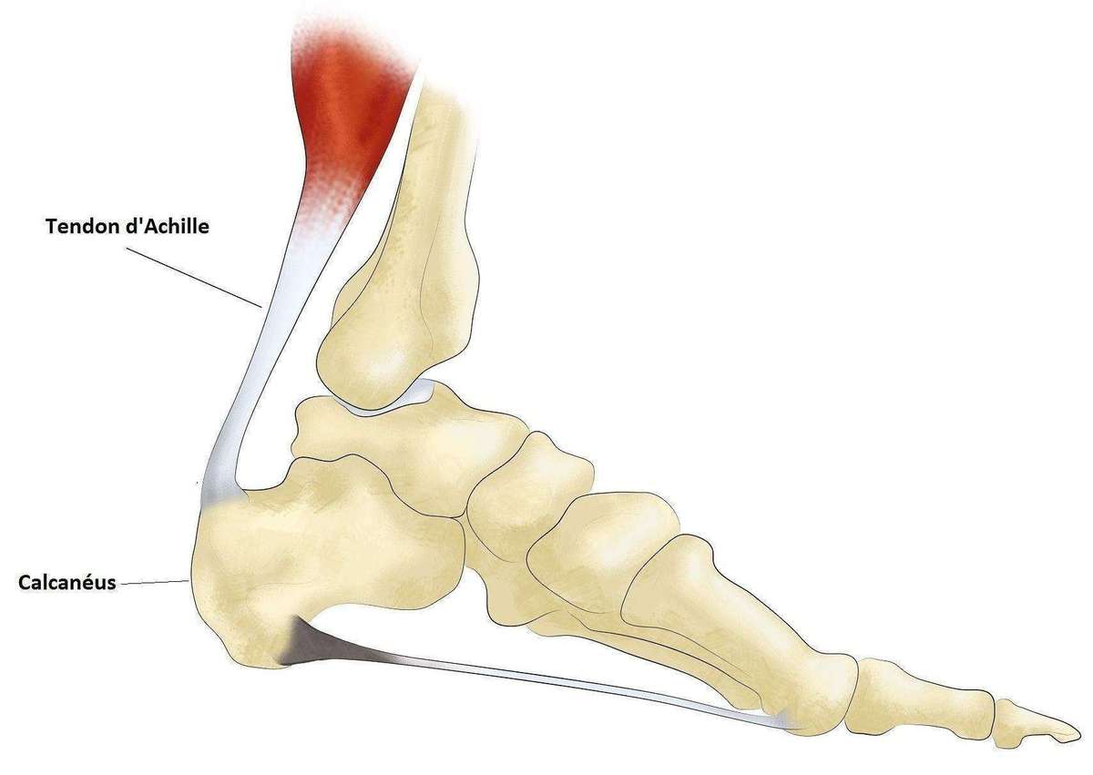La maladie de Sever: douleur talonnière de l'enfant | Articles