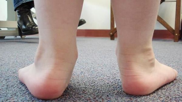 La maladie de Sever: douleur talonnière de l'enfant | Articles