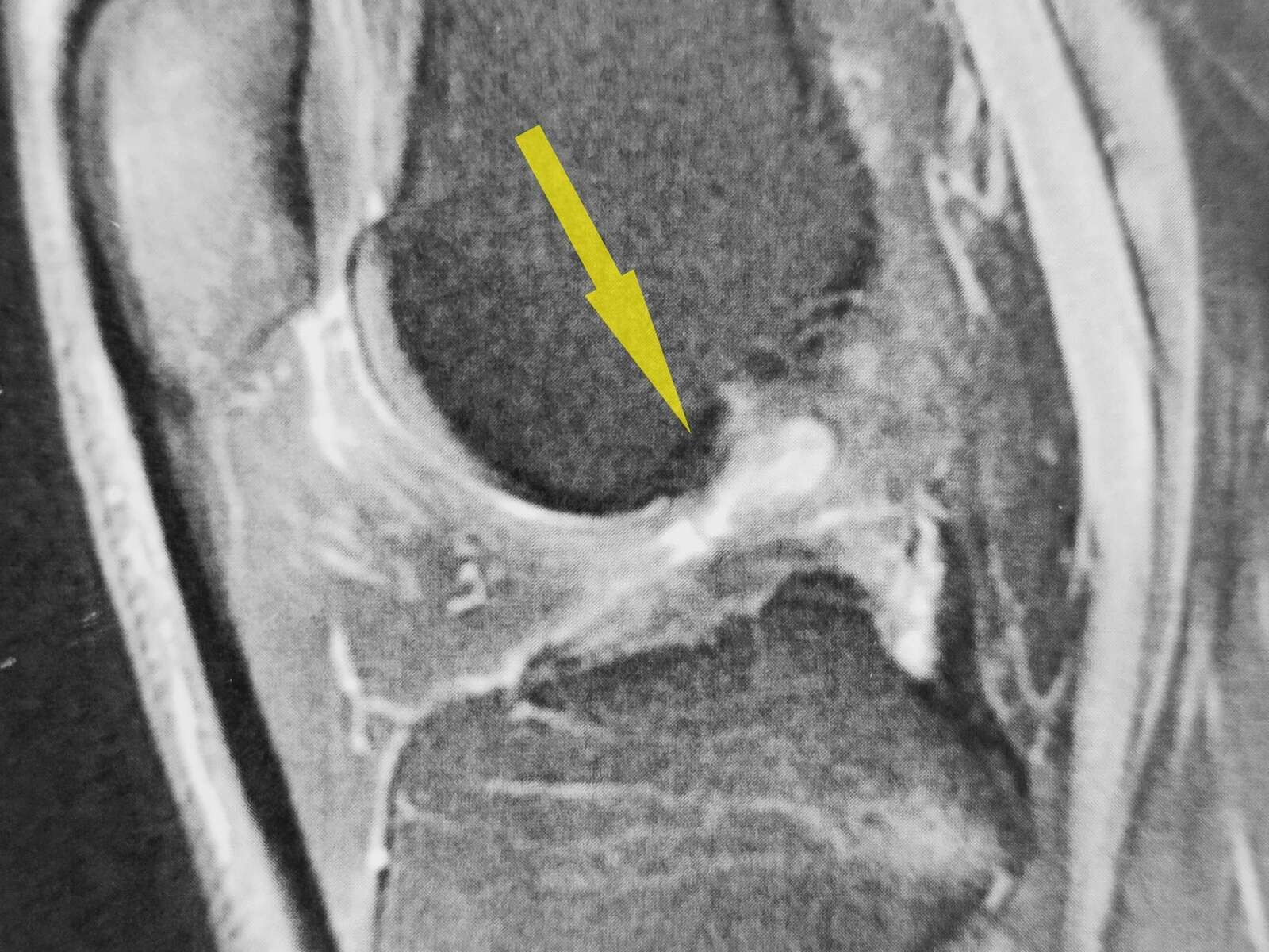 Les Lésions Ligamentaires du Genou à Marseille
