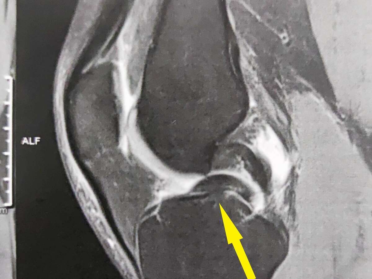Les Lésions Ligamentaires du Genou à Marseille