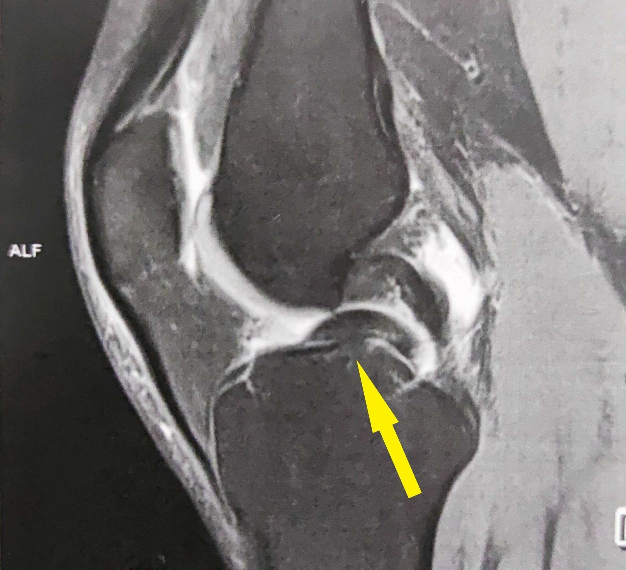 Les Lésions Ligamentaires du Genou à Marseille