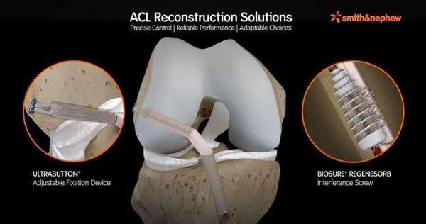 Opération Ligament croisé antérieur à Marseille