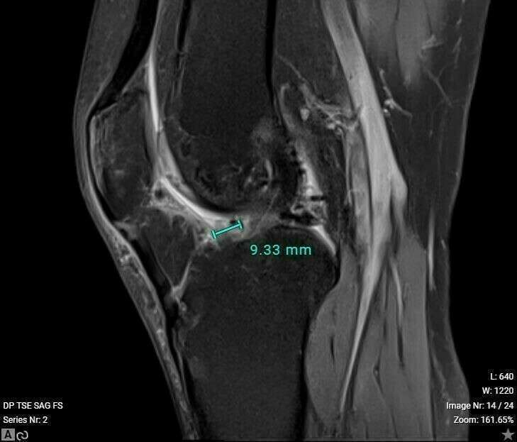 Le Cyclop Syndrom | Blog