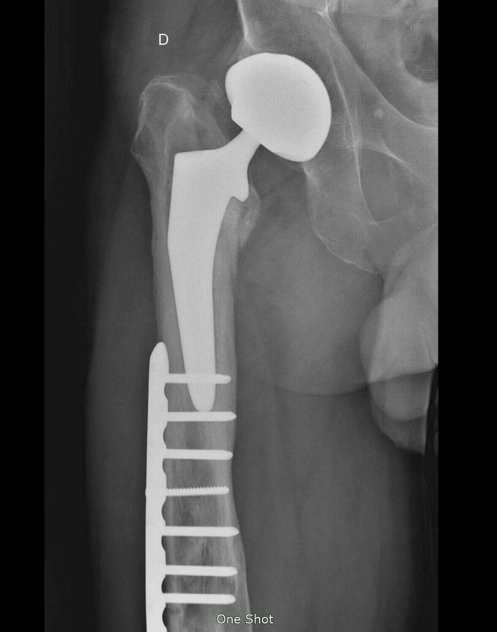 Fracture sur Prothèse | Blog