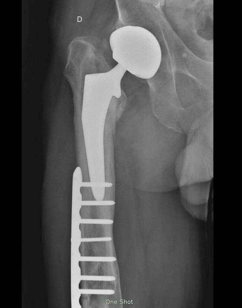 Fracture sur Prothèse | Blog
