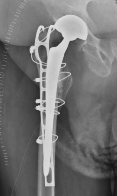 Fracture sur Prothèse | Blog