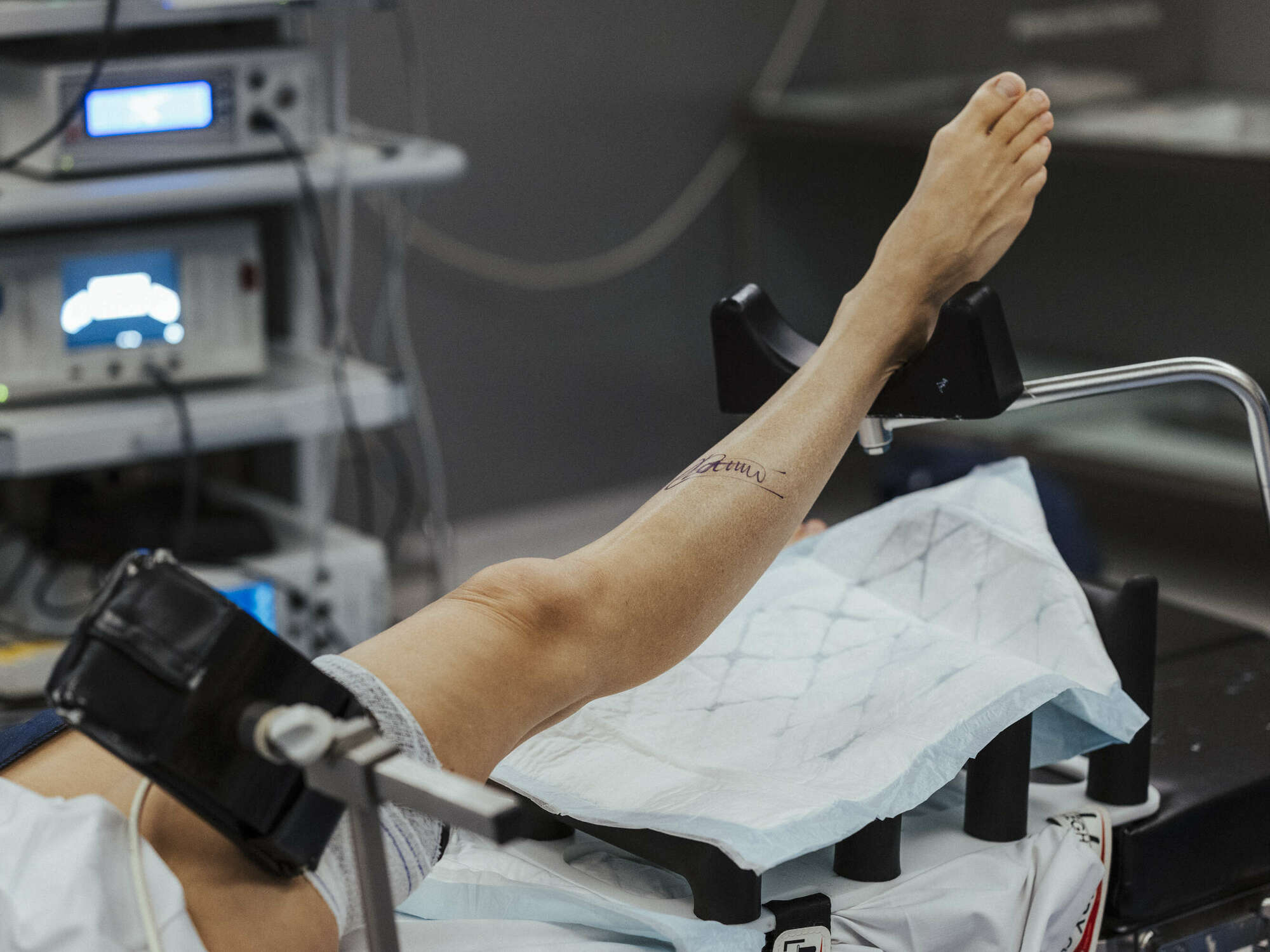 Injections intra-osseuses de plasma riche en plaquettes (PRP) dans l ...