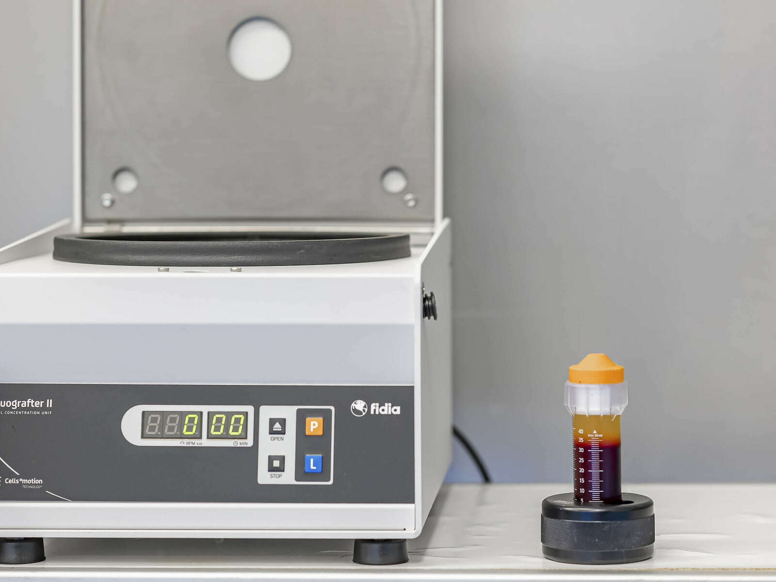 Injections intra-osseuses de plasma riche en plaquettes (PRP) dans l ...