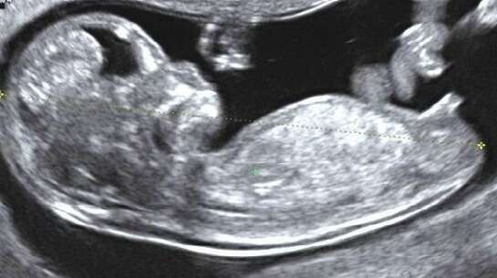 L'échographie de datation ou échographie précoce.