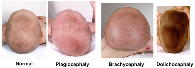 Aplatissement du crâne de bébé | Blog