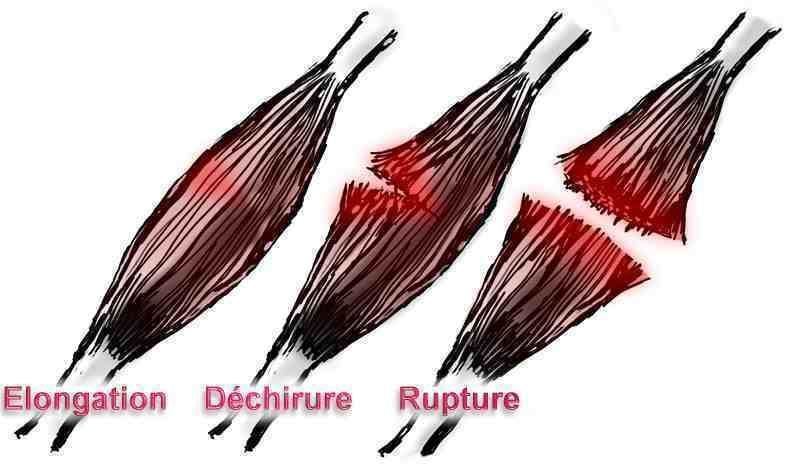 Les 7 traumatismes musculaires | Blog