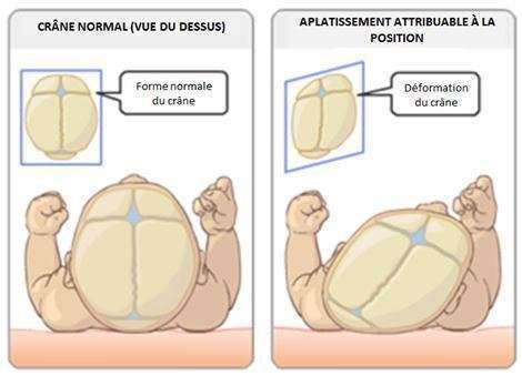 Aplatissement du crâne de bébé | Blog