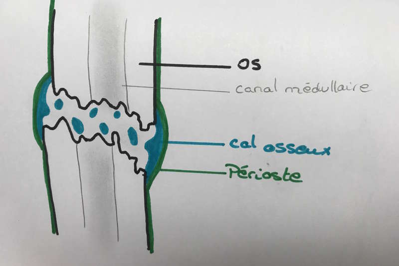 La fracture en pratique | Blog