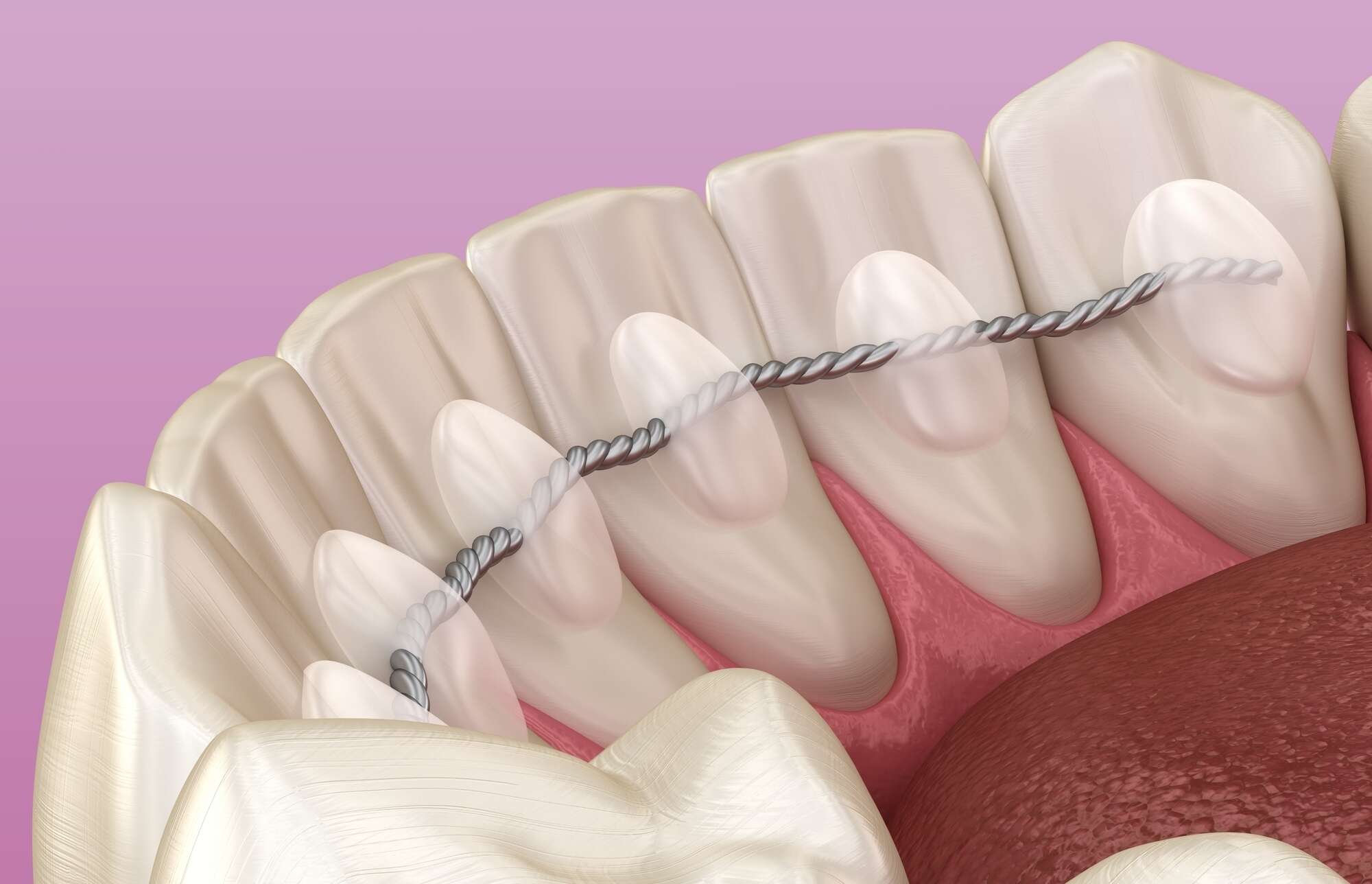 Les techniques de contention après un traitement orthodontique - Dr ...