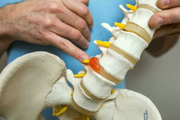 5 conseils dans la prise en charge des hernies discales L4/L5 L5/S1