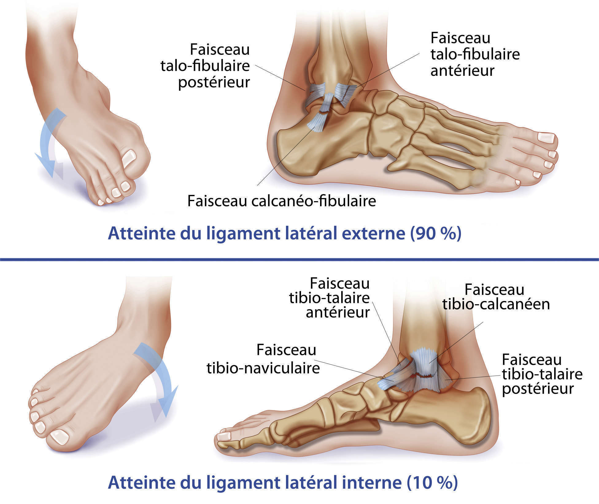 L'entorse de cheville | Blog