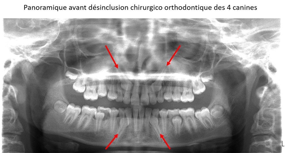 Dents incluses
