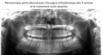 Dents incluses