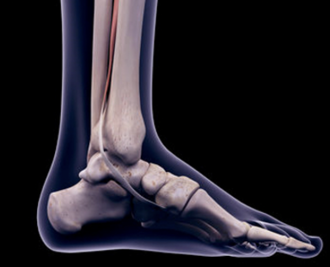 Maladie de Sever | Le Physioblog, conseils et informations ...