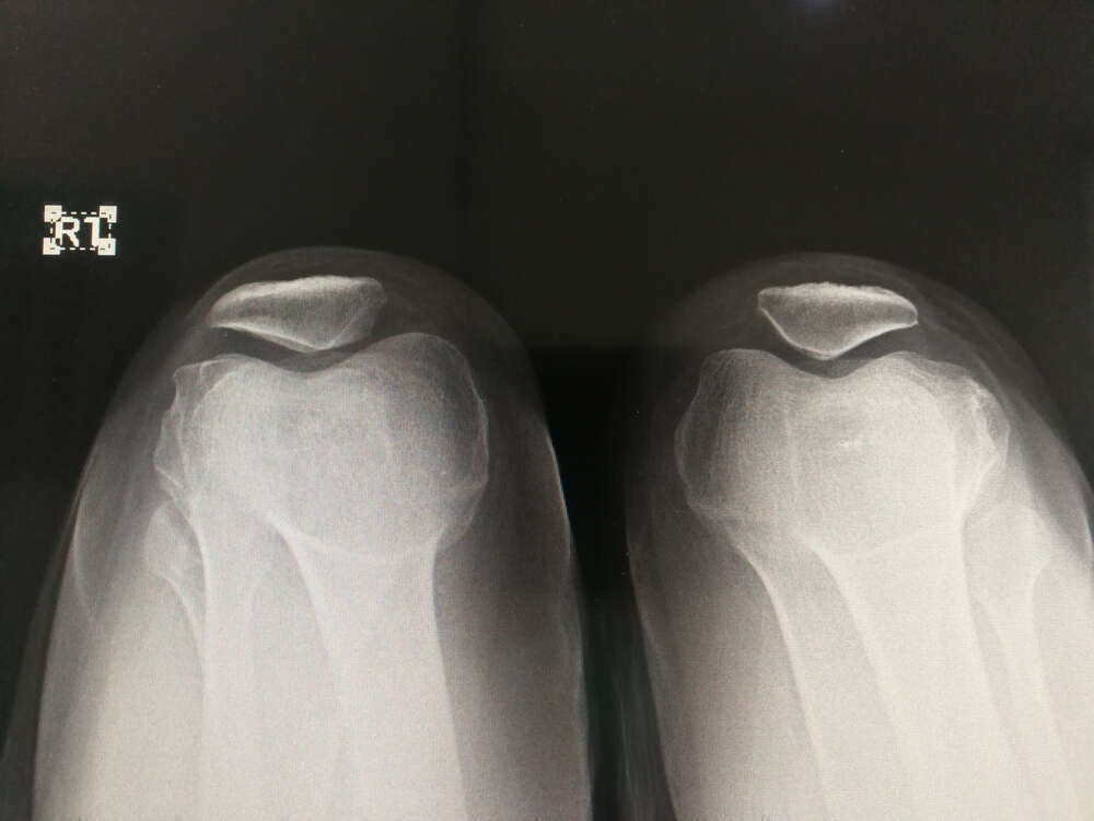 Le syndrome rotulien | AFC - Association Française de Chiropraxie