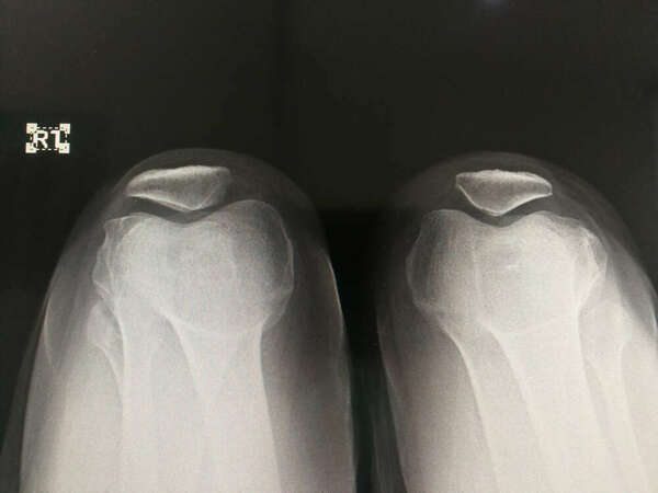 Le syndrome rotulien | AFC - Association Française de Chiropraxie