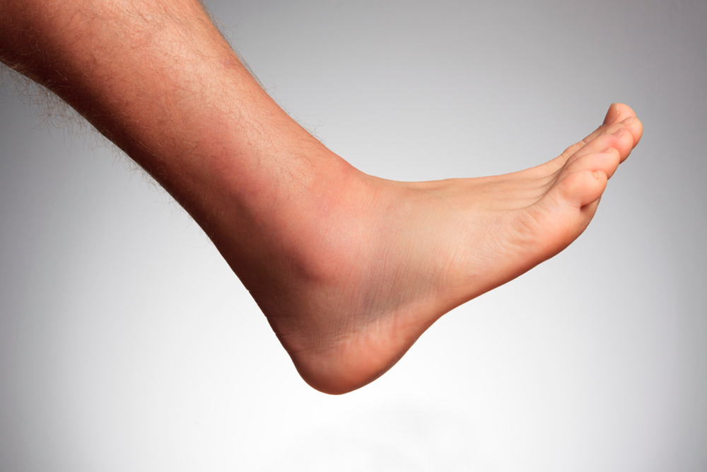 Chopart's sprain and osteopathy | Blog